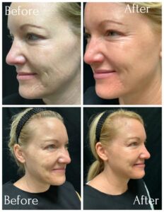 Before and Afters From My Morpheus 8 Treatment | #site_title